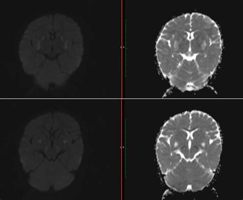 Restricted Diffusion With Corresponding Low Values On Adc In Bilateral