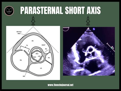 Parasternal Short Axis Tilting And Rotating By Alex C
