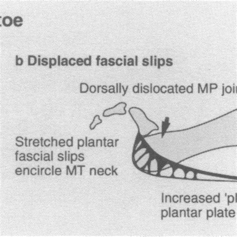 A Dorsiflexion Of The Big Toe And The Windlass Effect Of The Plantar Download Scientific