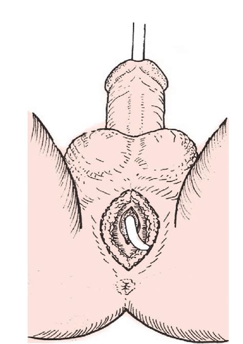 第九节 会阴部尿道切开术 泌尿外科手术