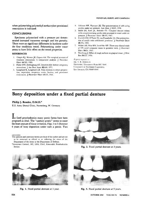 Pdf Bony Deposition Under A Fixed Partial Denture Dokumen Tips
