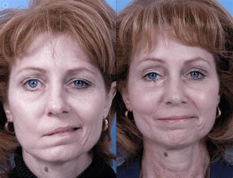 Everything About Bells Palsy News Dentagama