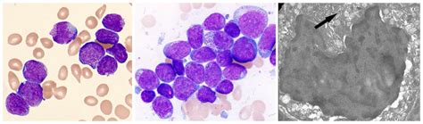 B Lymphoblastic Leukemia With Granules Left Circulating Lymphoblasts