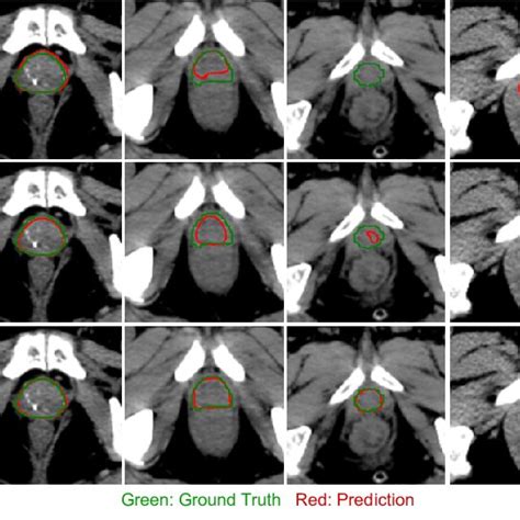 qualitative results of prostate segmentation by comparing our download scientific diagram