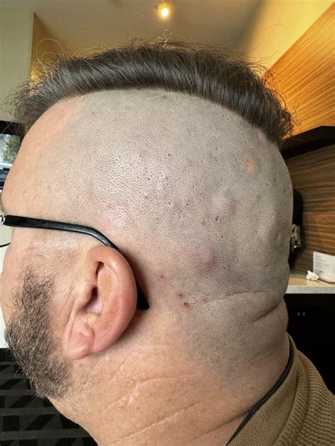 Sores And Issues On Scalp Rmedical