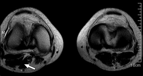 Ct Angiography And Mri In Patients With Popliteal Artery Entrapment