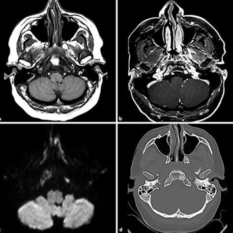 Case 2 Pre Gadolinium Left And Post Gadolinium Right Axial T1