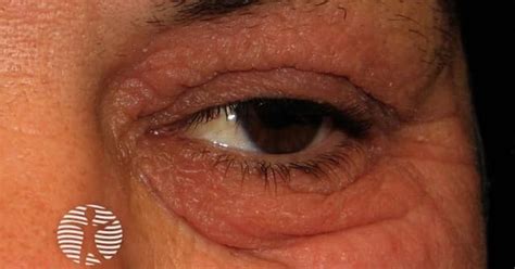 Contact Allergic Dermatitis Around The Eye Image