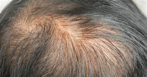 Hair Thinning In Men Signs Causes And Treatments