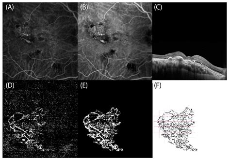 choroidal neovascularization oct