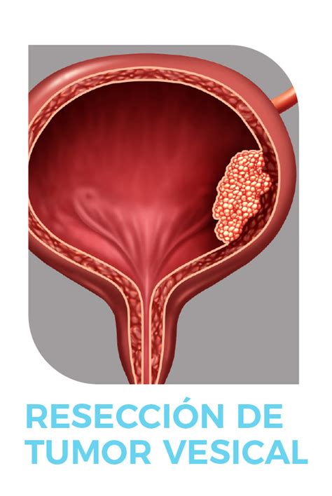 ResecciÓn De Tumor Vesical Urology Pv