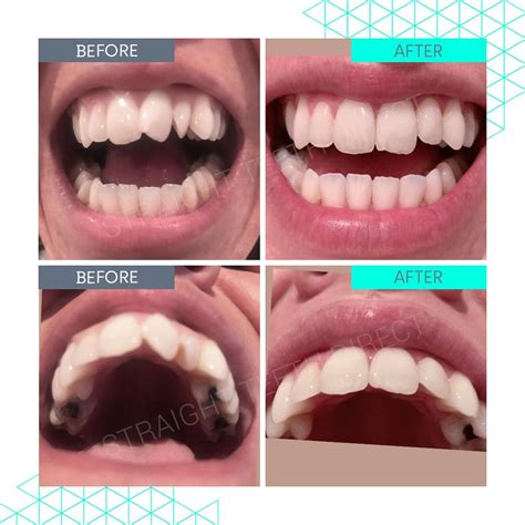 Invisible Teeth Braces At Home Teeth Straightening Made Simple