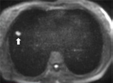 A Nodular Lesion Arrow In The Right Middle Lobe A Tse T2wi B