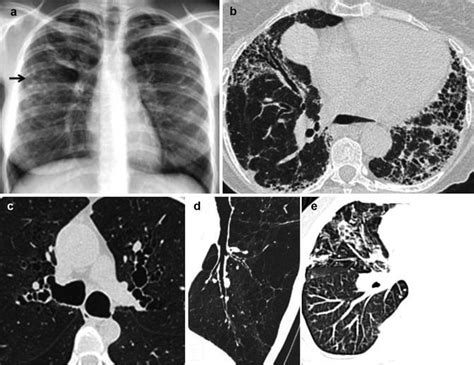 Airway Disease Pmc