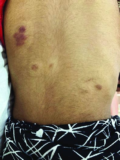 Plexiform Neurofibroma Download Scientific Diagram