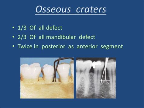 How To Determine The Osseous Defect Of Bone At Donna Bull Blog