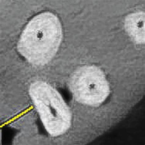 Cbct Scan Of The Maxillary Molar Shown In Figure 3 Download Scientific Diagram