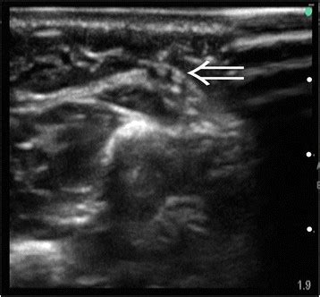 Ultrasound Guided Catheterisation For The Cephalic Vein In The Proximal