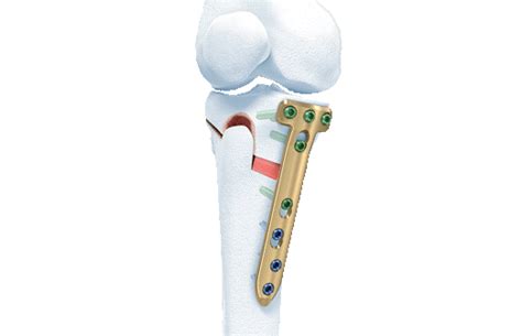 Tomofix® System Depuy Synthes