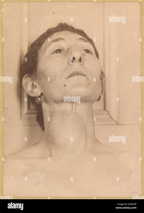 Woman With A Cyst Or Cystic Adenoma Affecting The Right Lobe Of The