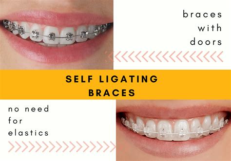Damon Braces Vs Traditional Braces