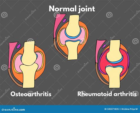 Different Joints Comparison Bone Disease Illustration Biology Stock