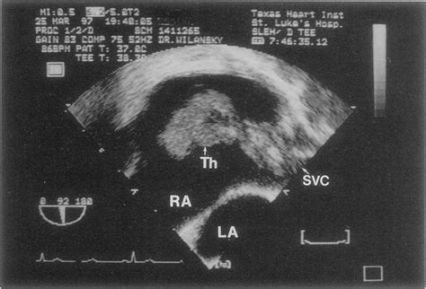 Transesophageal Echocardiogram Showing Thrombus Th Arising From The