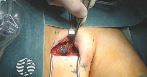 Dye Seen In Lymph Node During Sentinel Node Biopsy Image