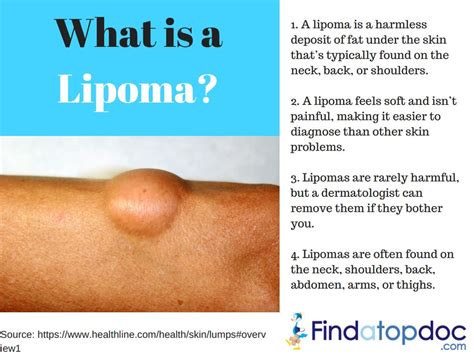 Findatopdoc Blog What Is A Lipoma Symptoms