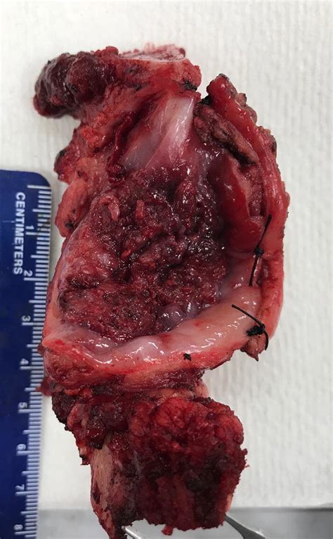 Right Segmental Mandibulectomy With Revised Buccal Mucosal Margin