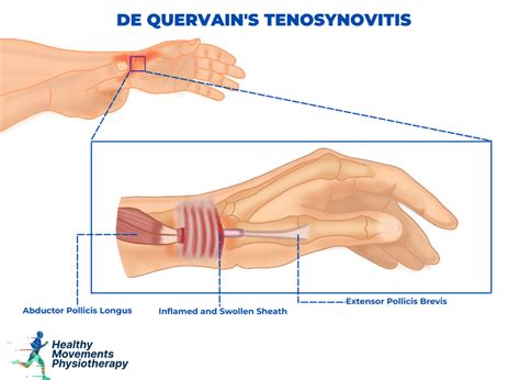 Wrist And Hand Injuries Healthy Movements Physiotherapy