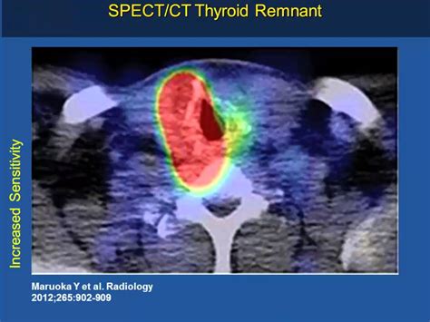 03 Spect Ct In Thyroid Cancer Youtube