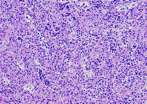 Manifest 2 Results Support “paradigm Shift” In Myelofibrosis Treatment