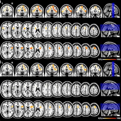 Spatial Distribution Of The Salience Network As Identified By