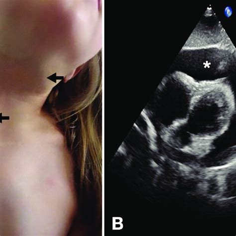 A Vascular Anomaly With Subcutaneous Cervical Component And Thoracic