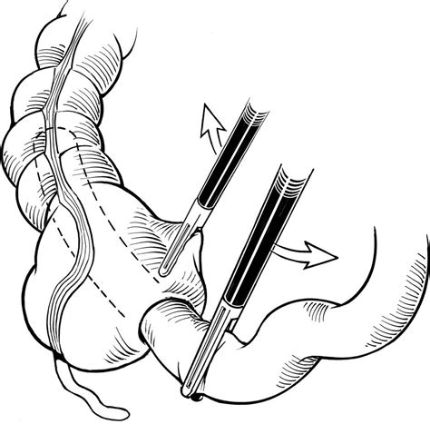 Laparoscopic Management Of Intussusception Clinical Tree