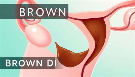 Understanding Brown Discharge And Pcos Key Insights