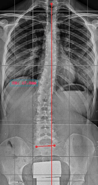 Coronal Balance How To Perform