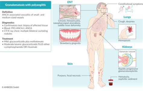 Pathoma Vasculitis Flashcards Quizlet