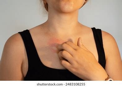 Rash Chest Royalty Free Images Stock Photos Pictures Shutterstock