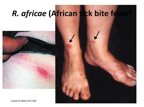 Ppt Rickettsial Diseases And Lyme Africom Focus Powerpoint