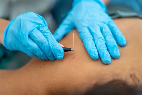 What Is Dry Needling Trigger Point Dry Needling In Austin Tx Frwd Sports Therapy