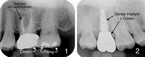Dentist Root Canal Tooth Vs Implant Looking At Dental X Ray ⛵️ 🏰