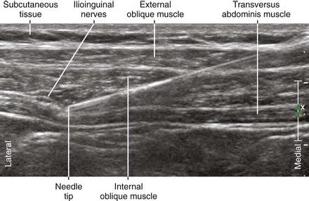 Ilioinguinal Nerve Block Clinical Gate