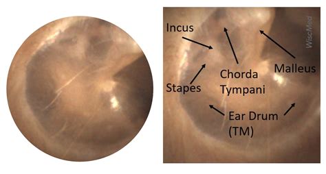 Tympanic Membrane Anatomy 1 Anatomy Of The Ear Veterian Key