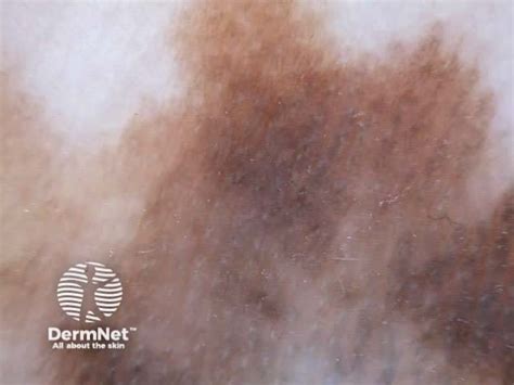 Dermoscopy Pattern Analysis