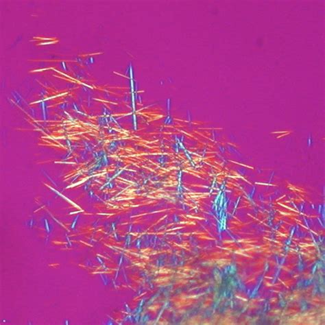 Gout Crystals