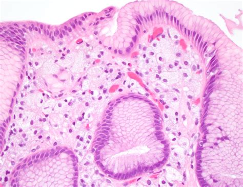 Histologia Dos Xantomas Xantoma Histodiagnostico Patologia