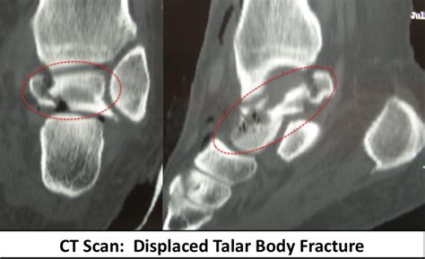 Talar Body Fracture Footeducation