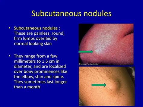 Ppt Rheumatic Fever And Rheumatic Heart Disease Powerpoint